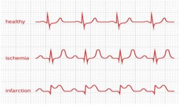 Transitional Ischemic attack (TIA) - Stroke Therapy (R)evolution